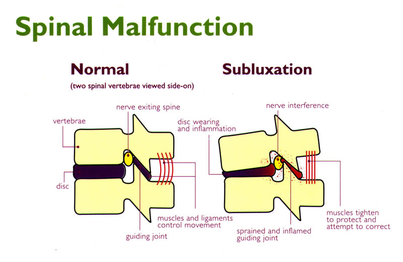 Spinal Malfunction | Burlington NC Chiropractor - Cardinal Chiropractic ...